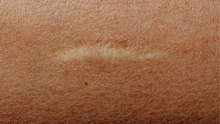 Adhérences cicatricielles : et si vos cicatrices racontaient plus que ...